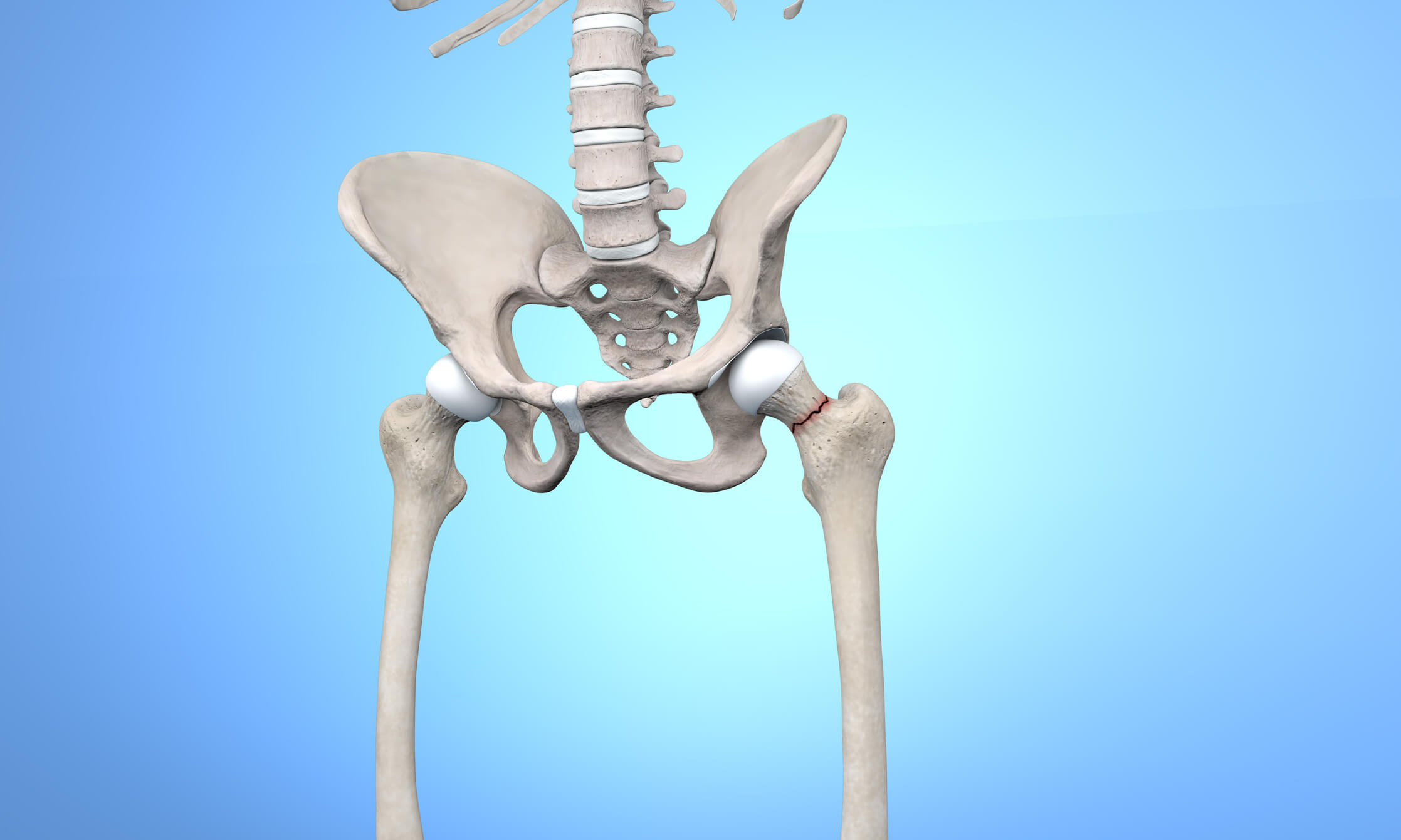 An In-Depth Guide to Hip Surgery from TiOS in Texas